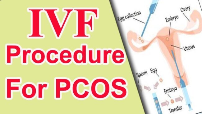 IVF Treatment and Polycystic Ovary Syndrome (PCOS): Diagnosis and ...